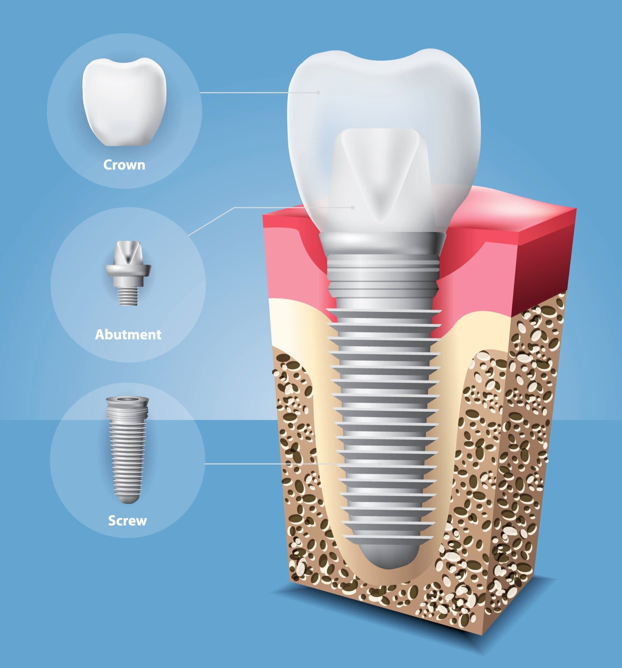 Dental Implants Emu Plains | Emu Plains Family Dental
