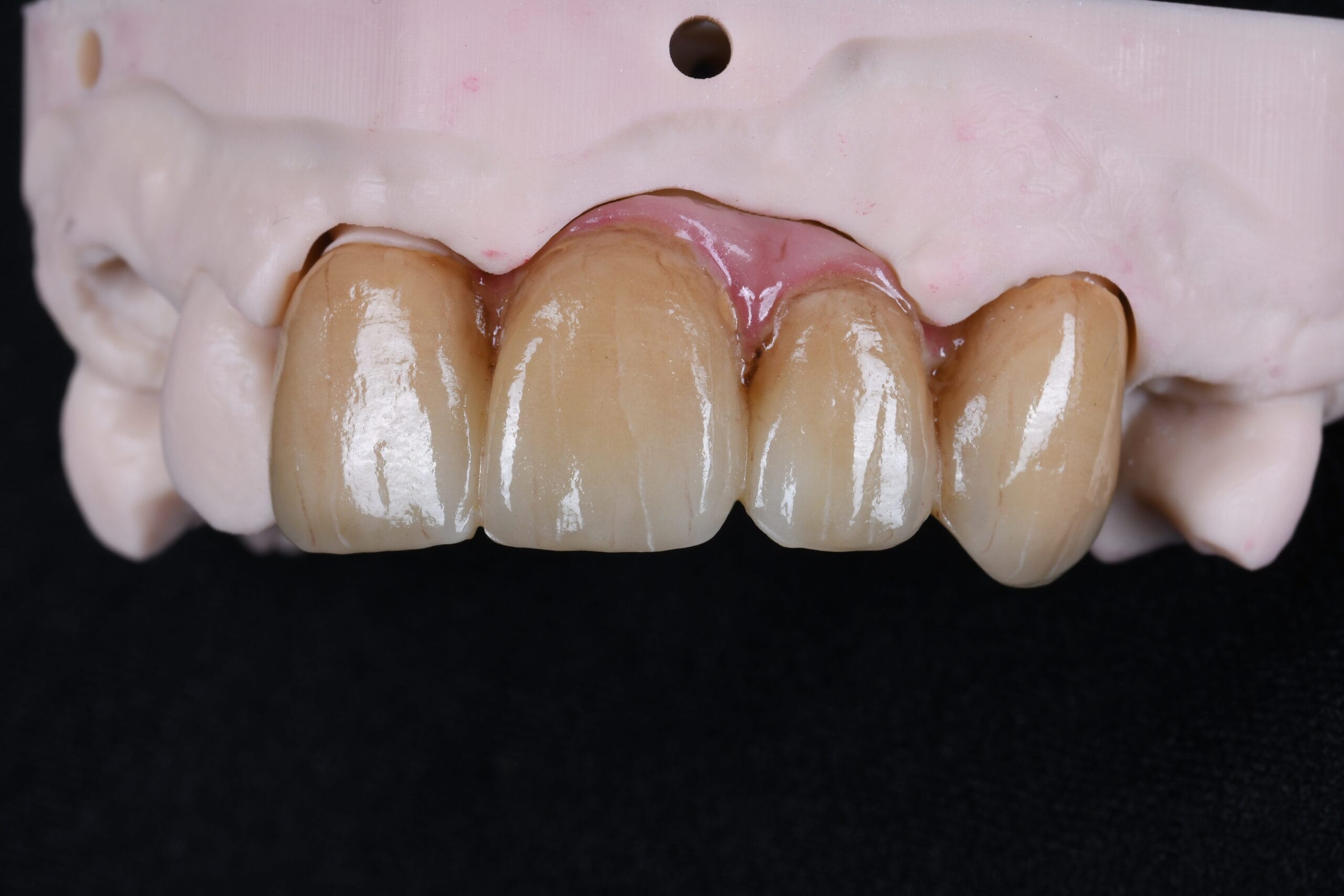 Crown and Bridges Emu Plains | Emu Plains Family Dental