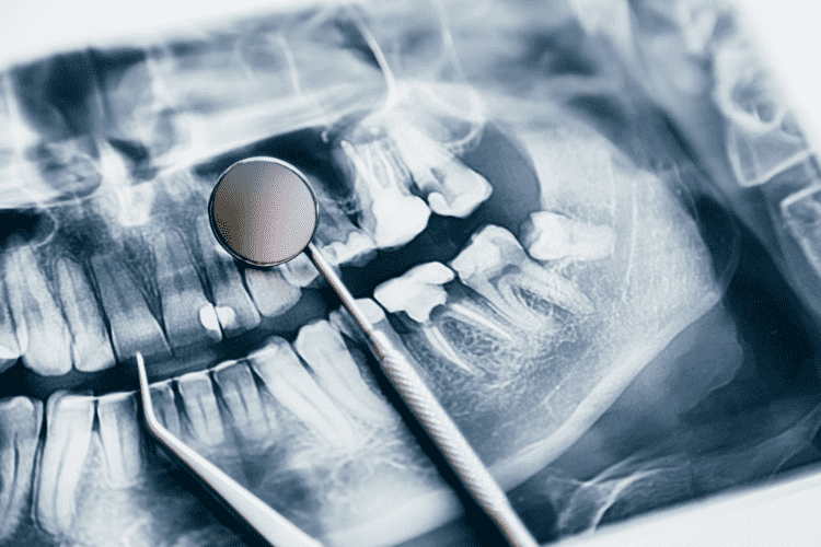 Wisdom Teeth and Crowded Teeth: Understanding the Connection